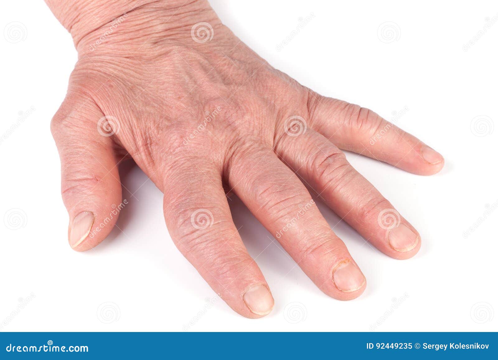 Rheumatoid Polyarthritis of Hands Isolated on White Background Stock ...
