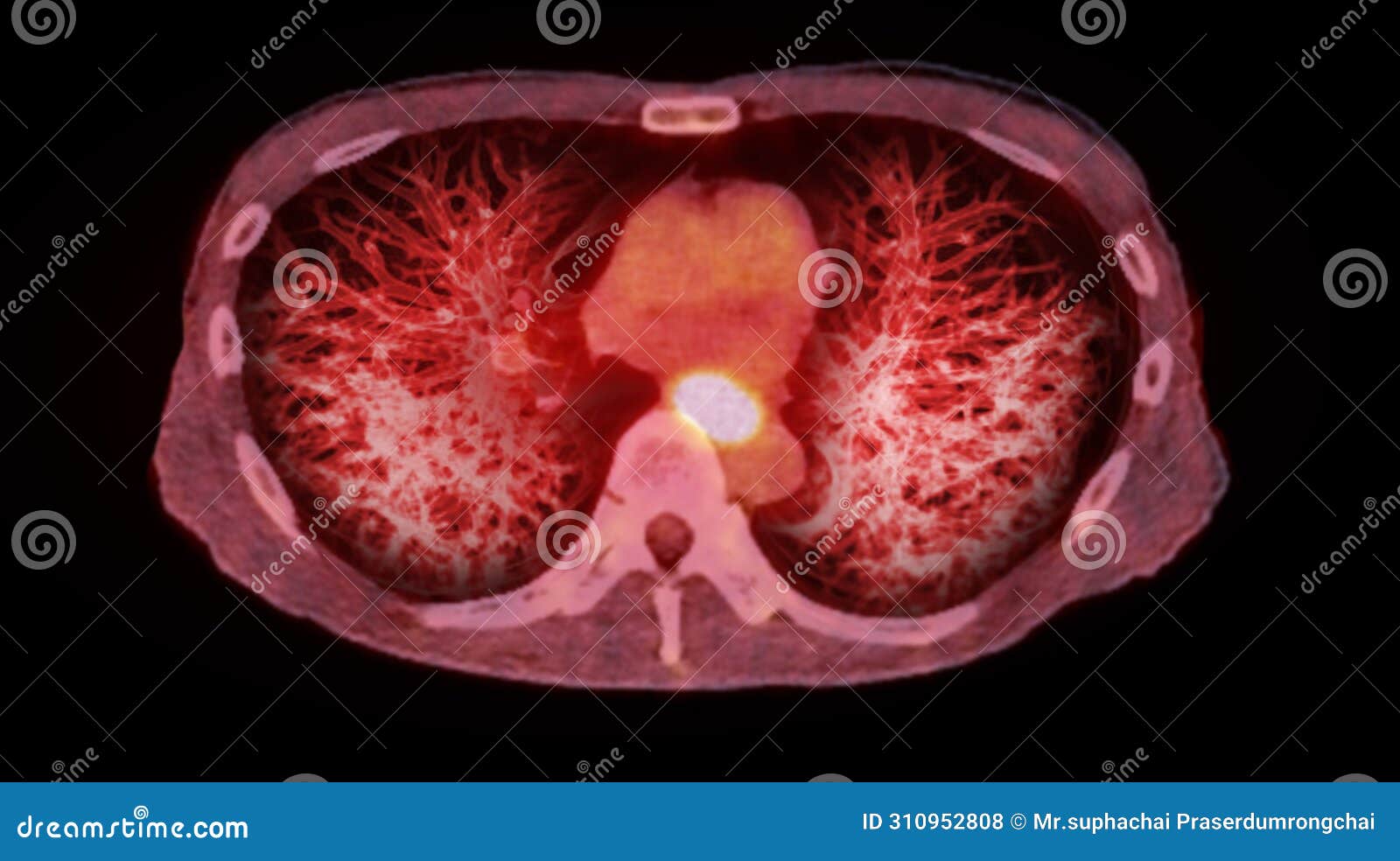Rheumatoider Arthritis Ch Brustkorb Oder Lunge 3D Bild Mit Trachea Und ...