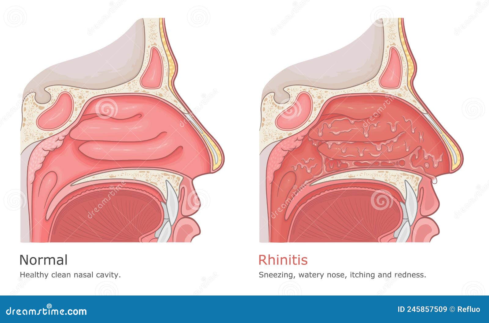 Rhinitis Medical Illustration Stock Vector - Illustration of normal ...