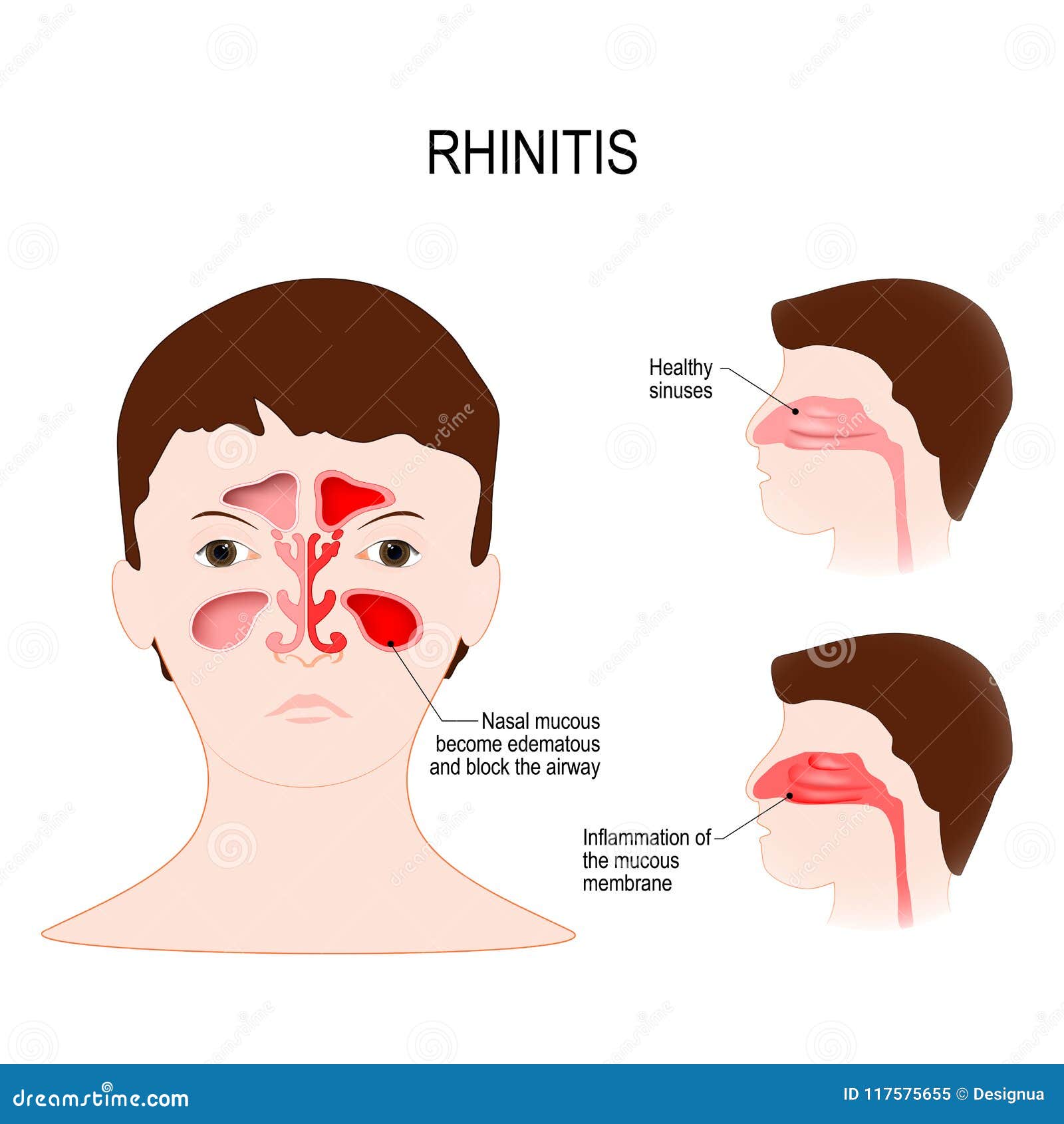 Rhinitiscoryza Gezonde Sinussen En Sinussen Met Ontsteking Vector ...