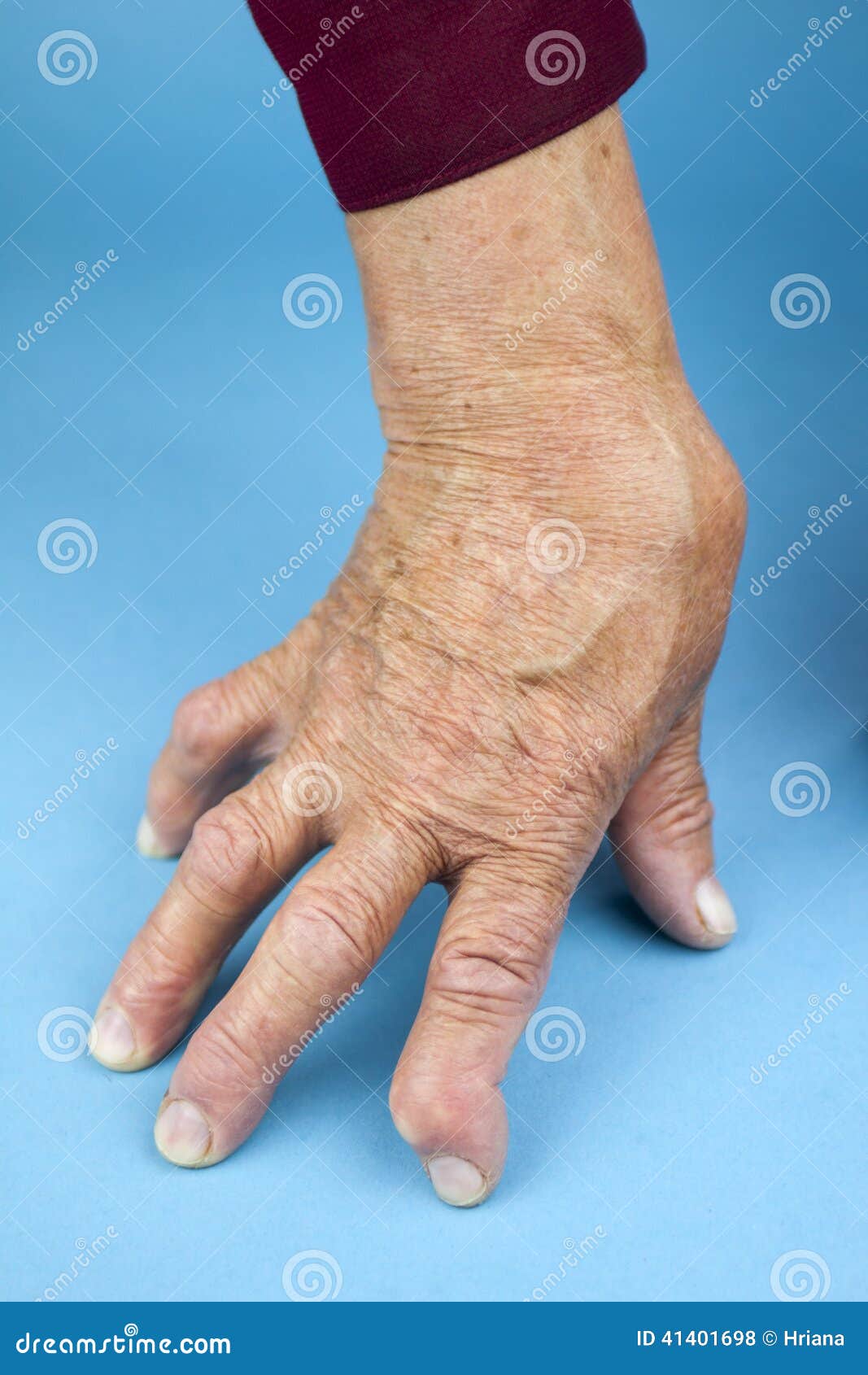 Rhumatisme articulaire photo stock. Image du patient - 41401698