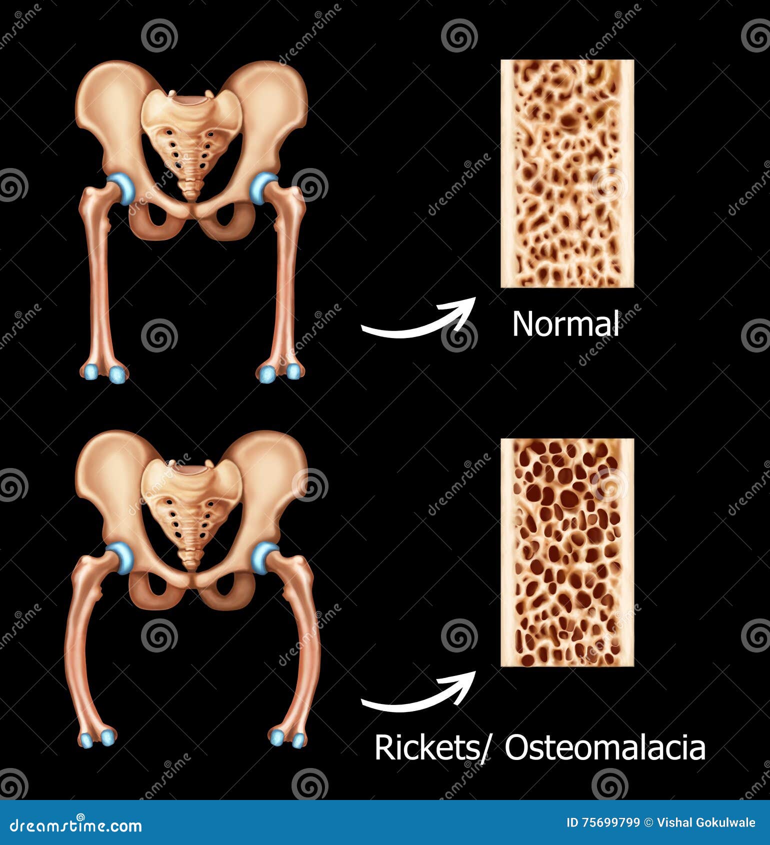 Rickets Cartoons, Illustrations & Vector Stock Images - 164 Pictures to ...