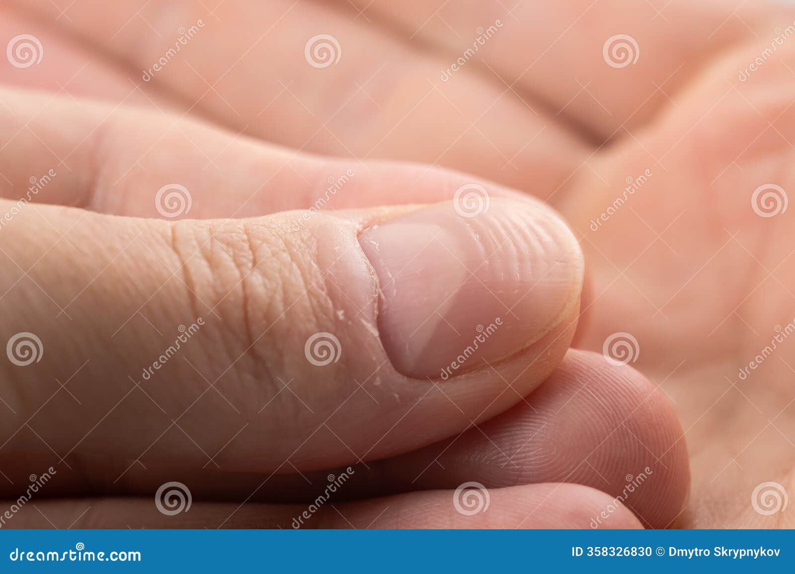 Ridged Fingernails With Vertical Ridges.Nails Problems Royalty-Free ...