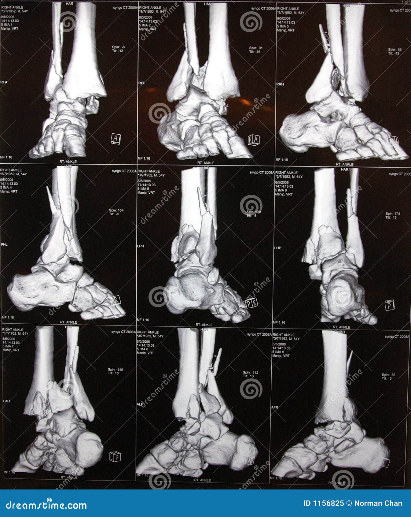 Right ankle CT stock image. Image of parts, doctor, skeleton - 1156825