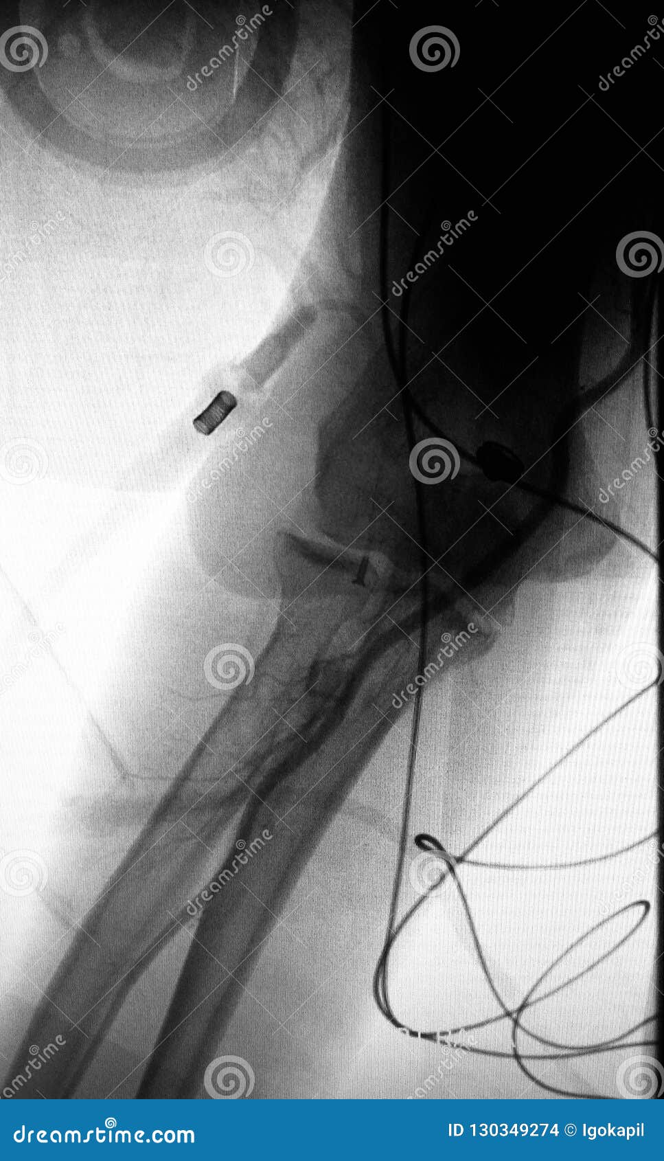 Right Arm Artery Catheterization Angiogramm Ct Stock Photo - Image of ...