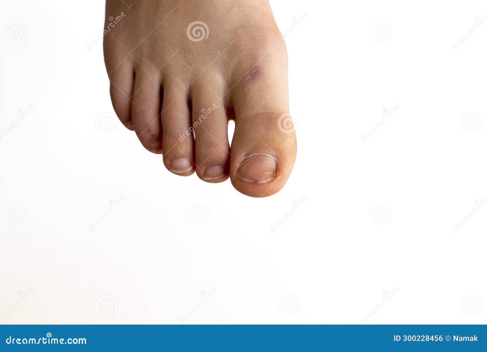 Right Foot Close-up on a White Background. Diseases of the Nails and ...