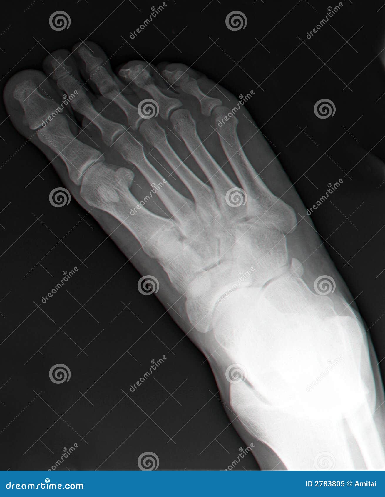 Right foot x-ray#2 stock image. Image of foot, healthcare - 2783805