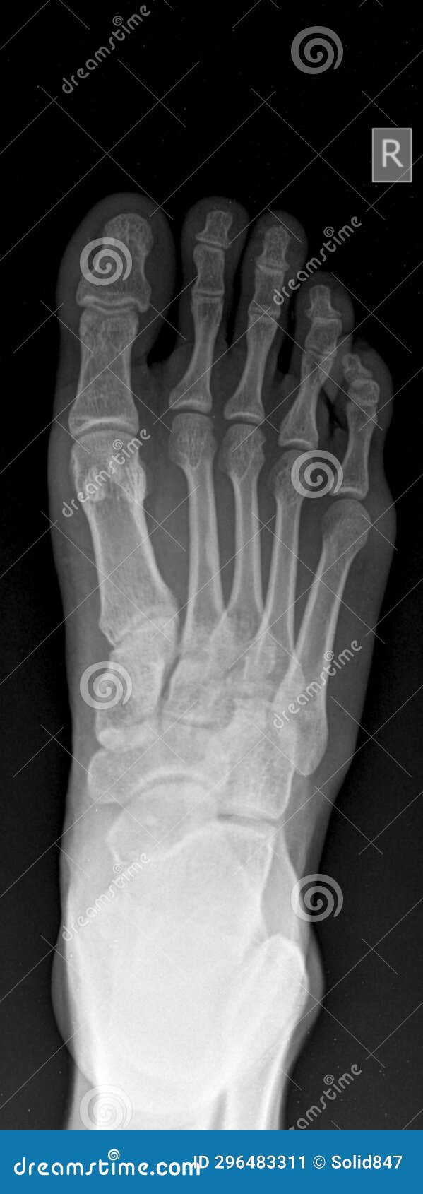 Right Foot X-ray Image AP View Stock Image - Image of muscle, bone ...