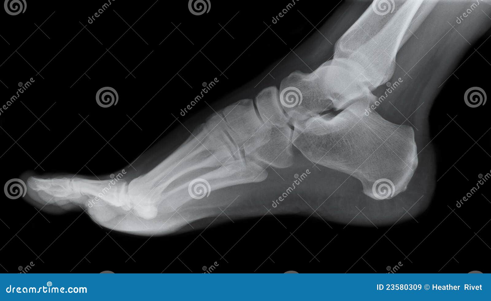 Right Foot Side X-ray stock image. Image of bone, hospital - 23580309