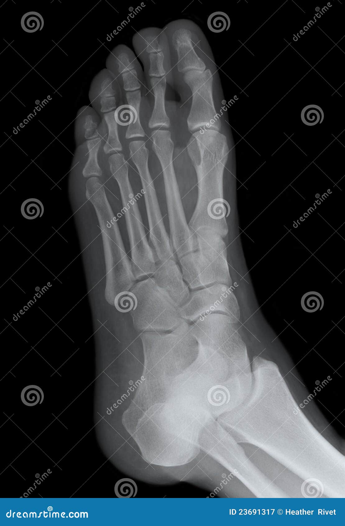 Right Foot Side X-ray stock image. Image of toes, right - 23691317