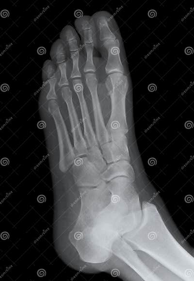 Right Foot Side X-ray stock image. Image of toes, right - 23691317