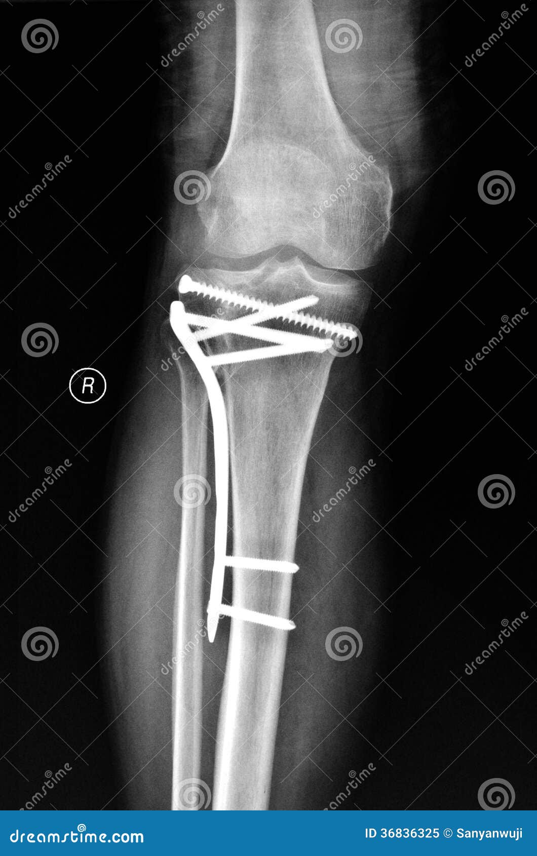 Right in Front of the Tibial Position X-ray Pictures Stock Image ...