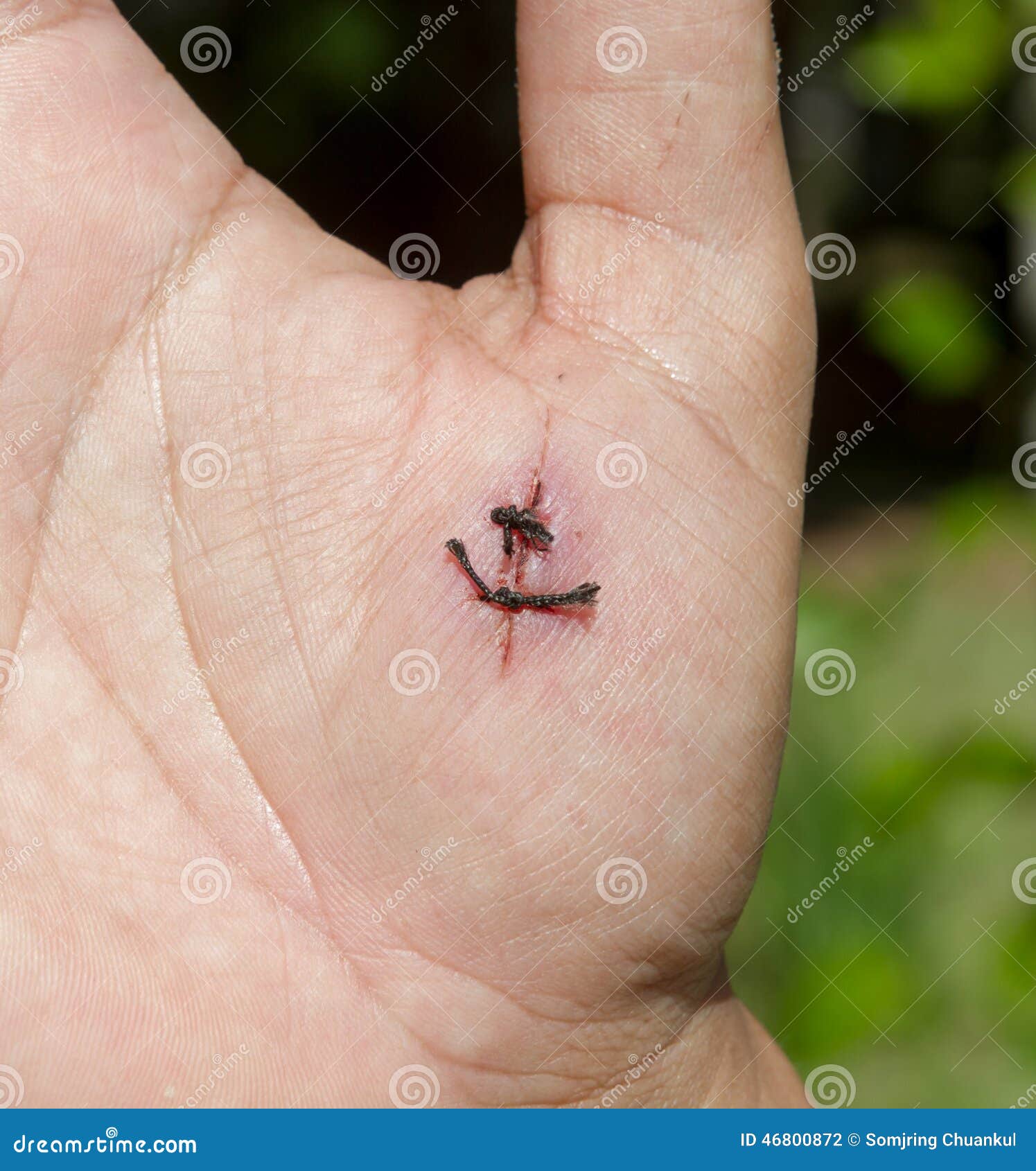 Right hand injury. stock photo. Image of surgery, human - 46800872