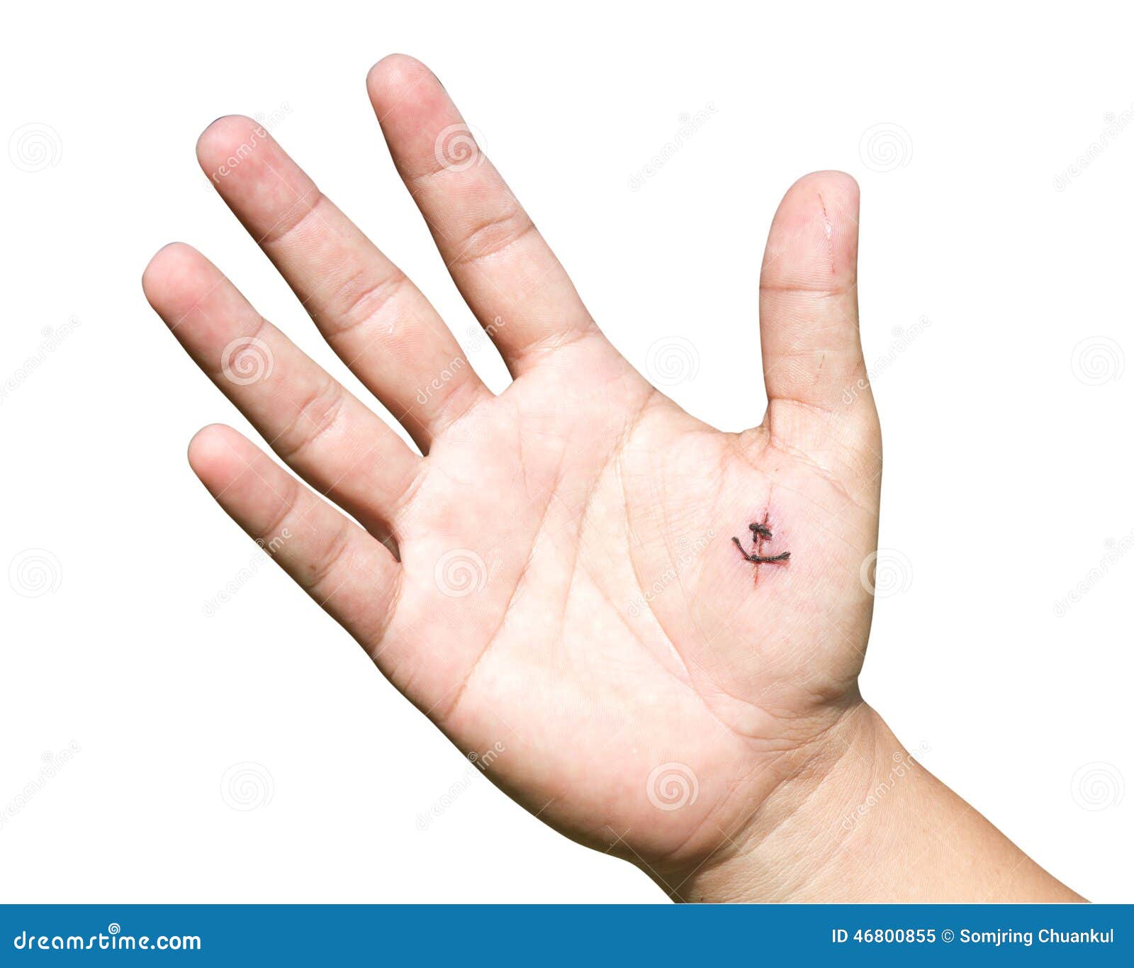 Right hand injury. stock image. Image of background, skin - 46800855