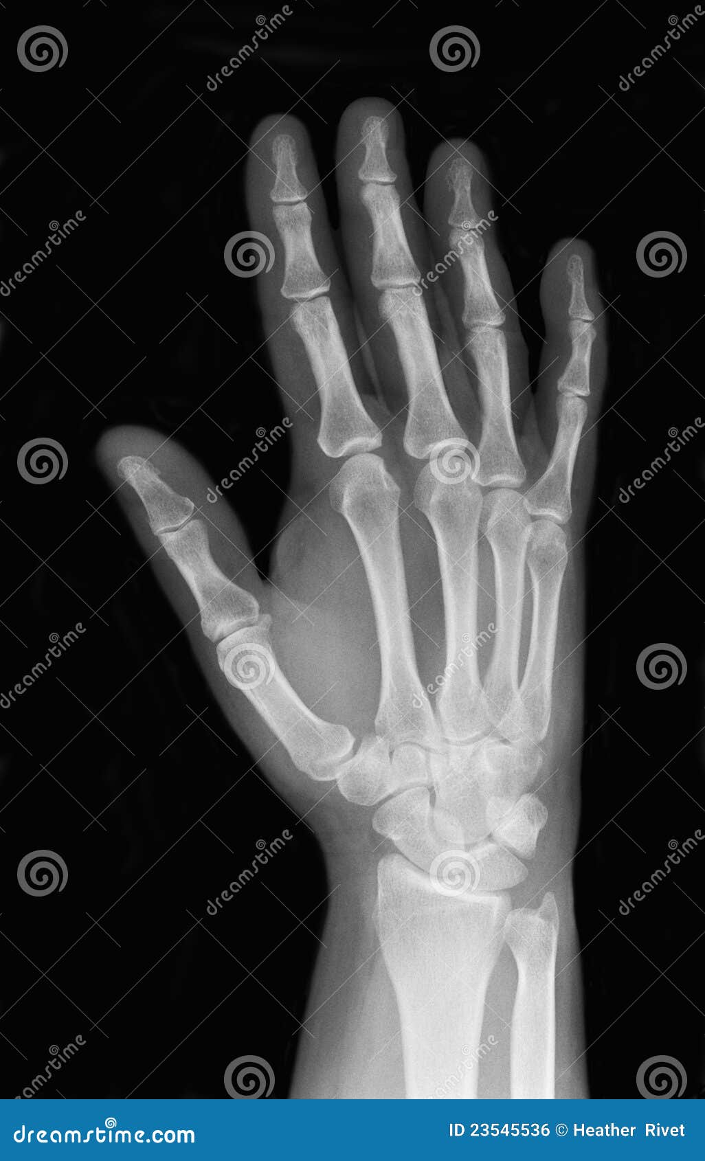 Right Hand X Ray