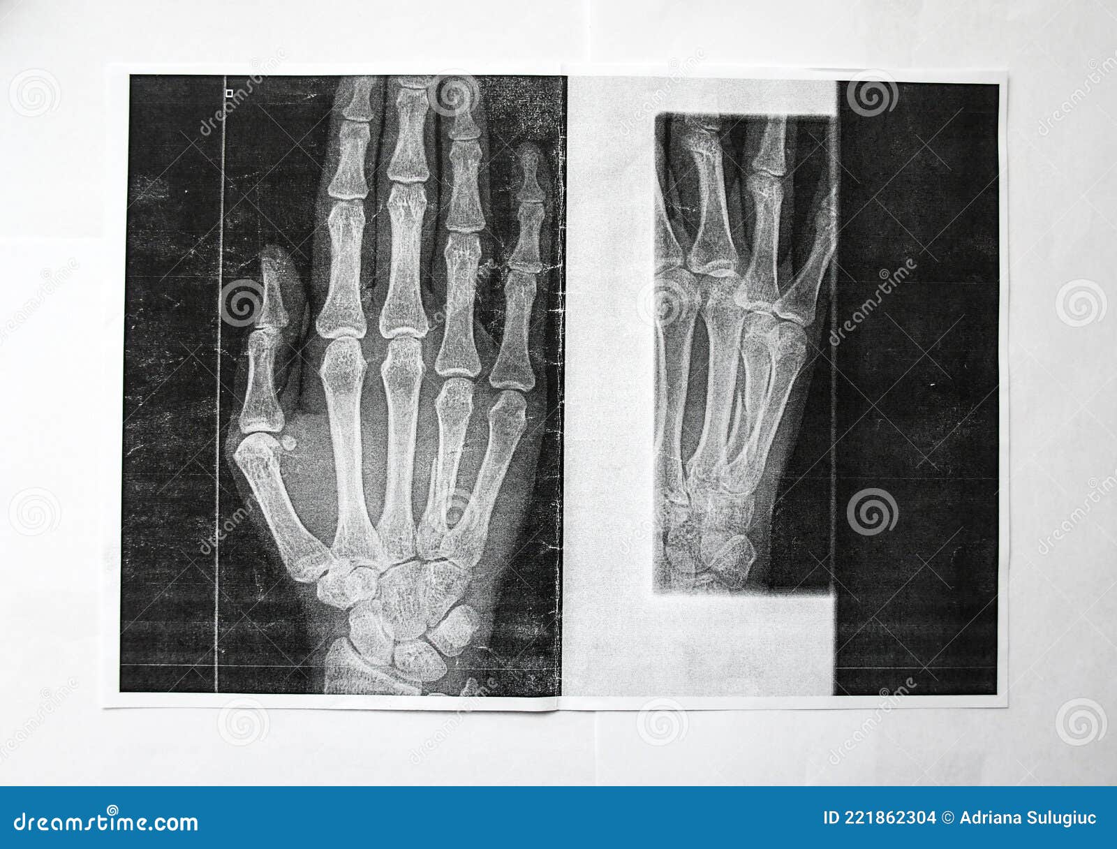 Right hand x ray image stock photo. Image of anatomy - 221862304