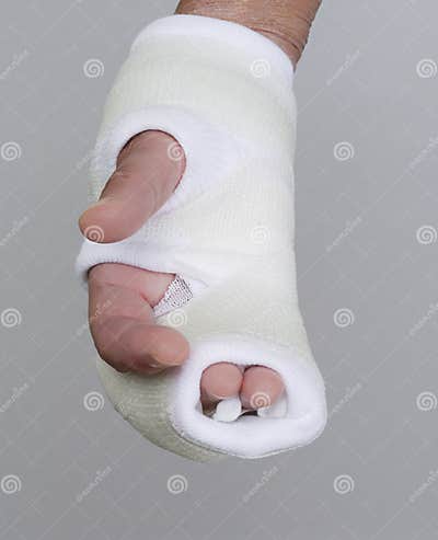 Right hand in white cast stock photo. Image of palm, bandage - 15947498