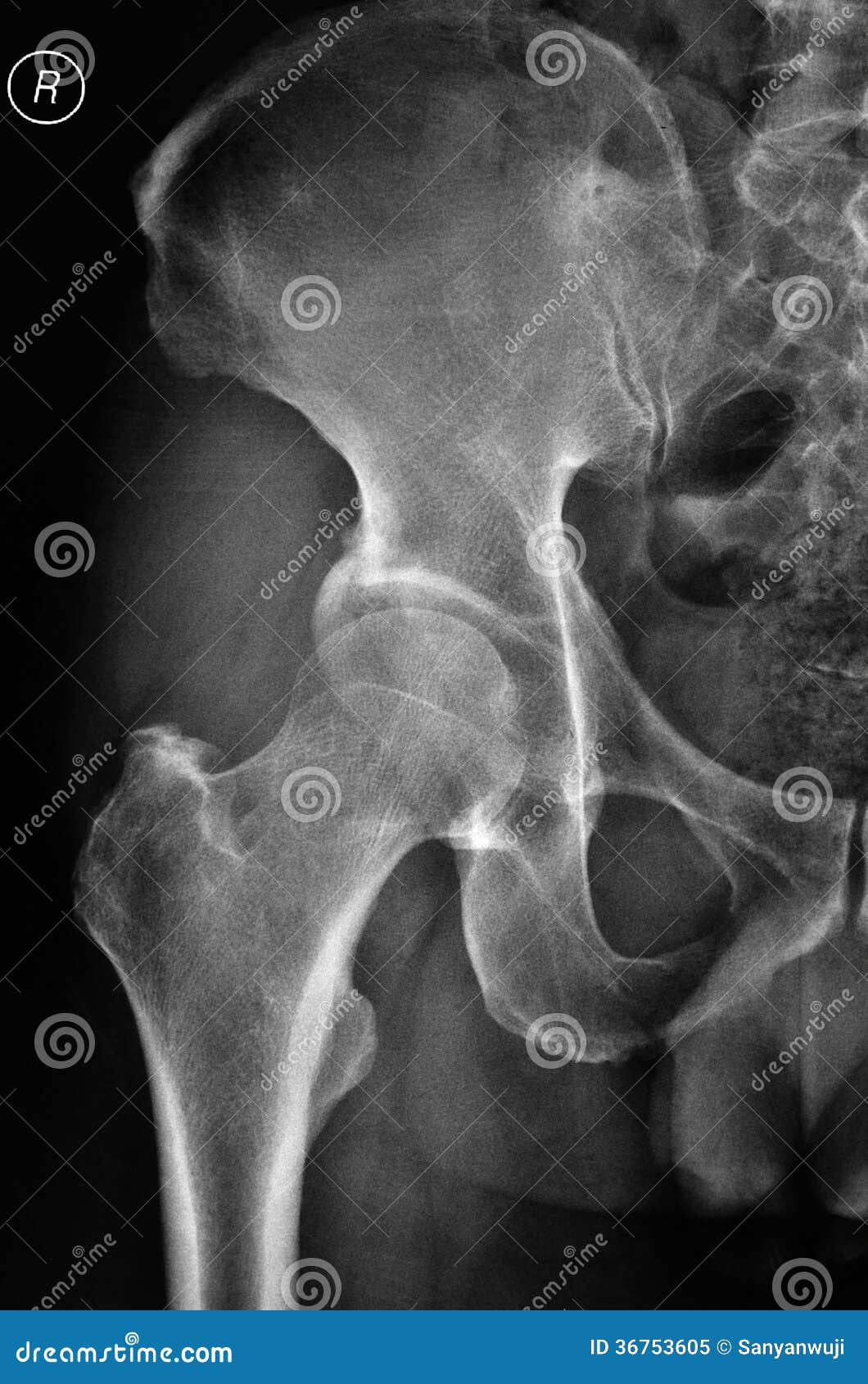 Right hip X-ray pictures stock image. Image of medical - 36753605