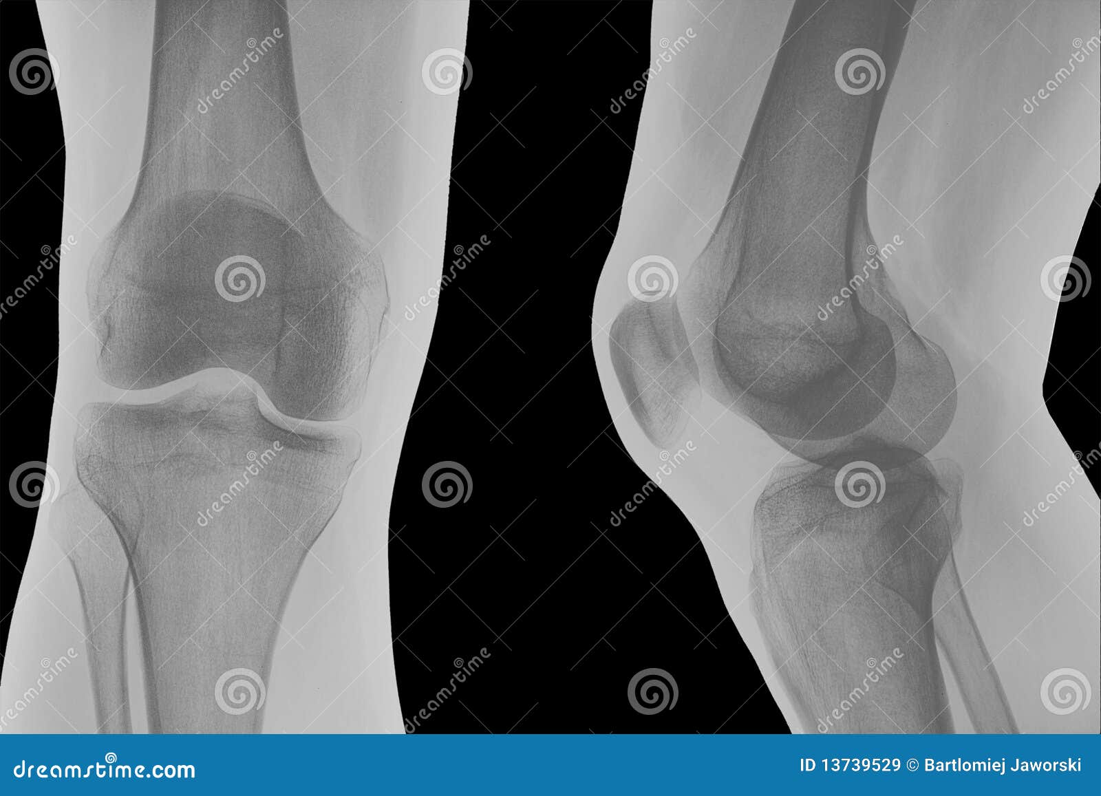 Right knee x-ray. stock image. Image of joint, bone, human - 13739529