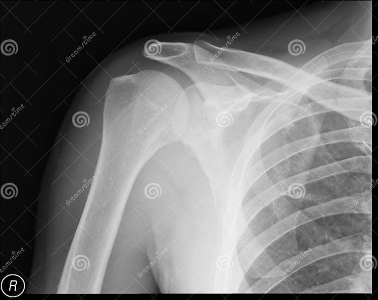 Right Shoulder X-ray. Radiograph. Anteroposterior View. Stock Photo ...