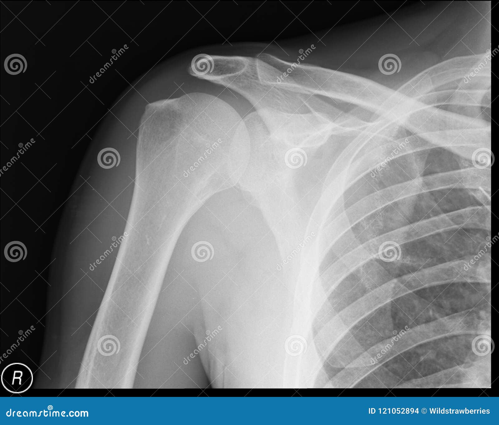 X-ray Image Of Clavicle, AP View. | CartoonDealer.com #59187298