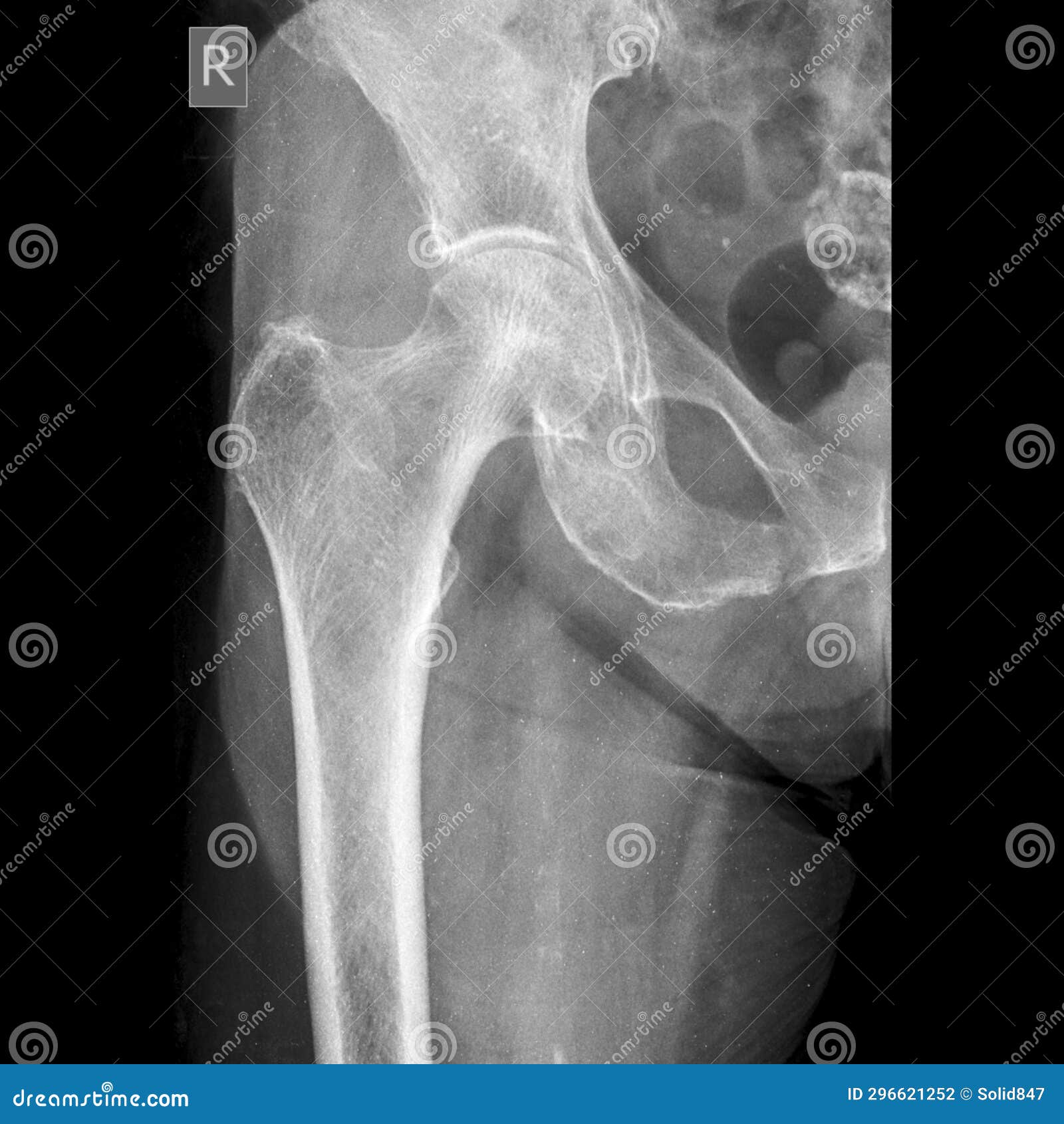 Hip Joint X-ray Image AP View Stock Photo - Image of radiograph ...