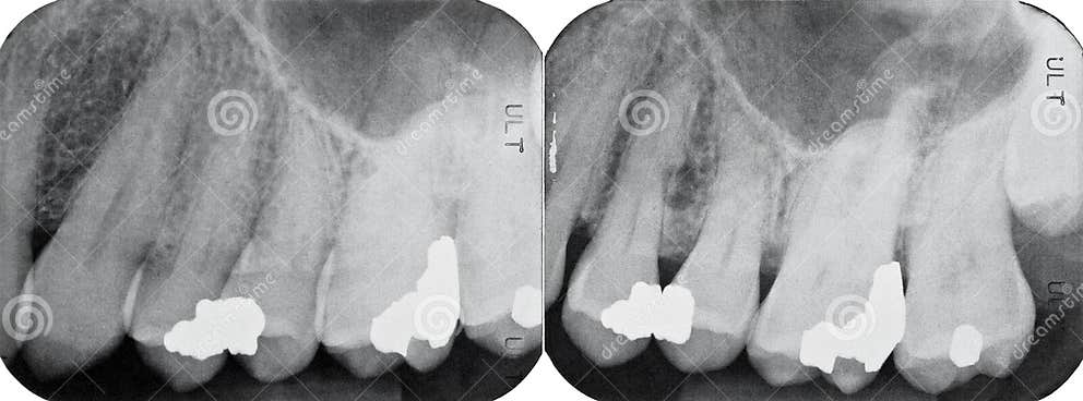 Right Upper Periodontal X-rays Stock Image - Image of black, dentin ...