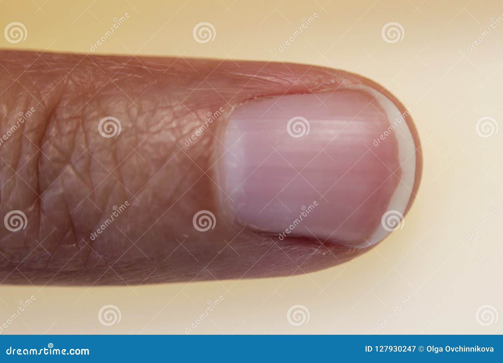 Burrs On The Finger. Inflammation And Abscess. Royalty-Free Stock ...