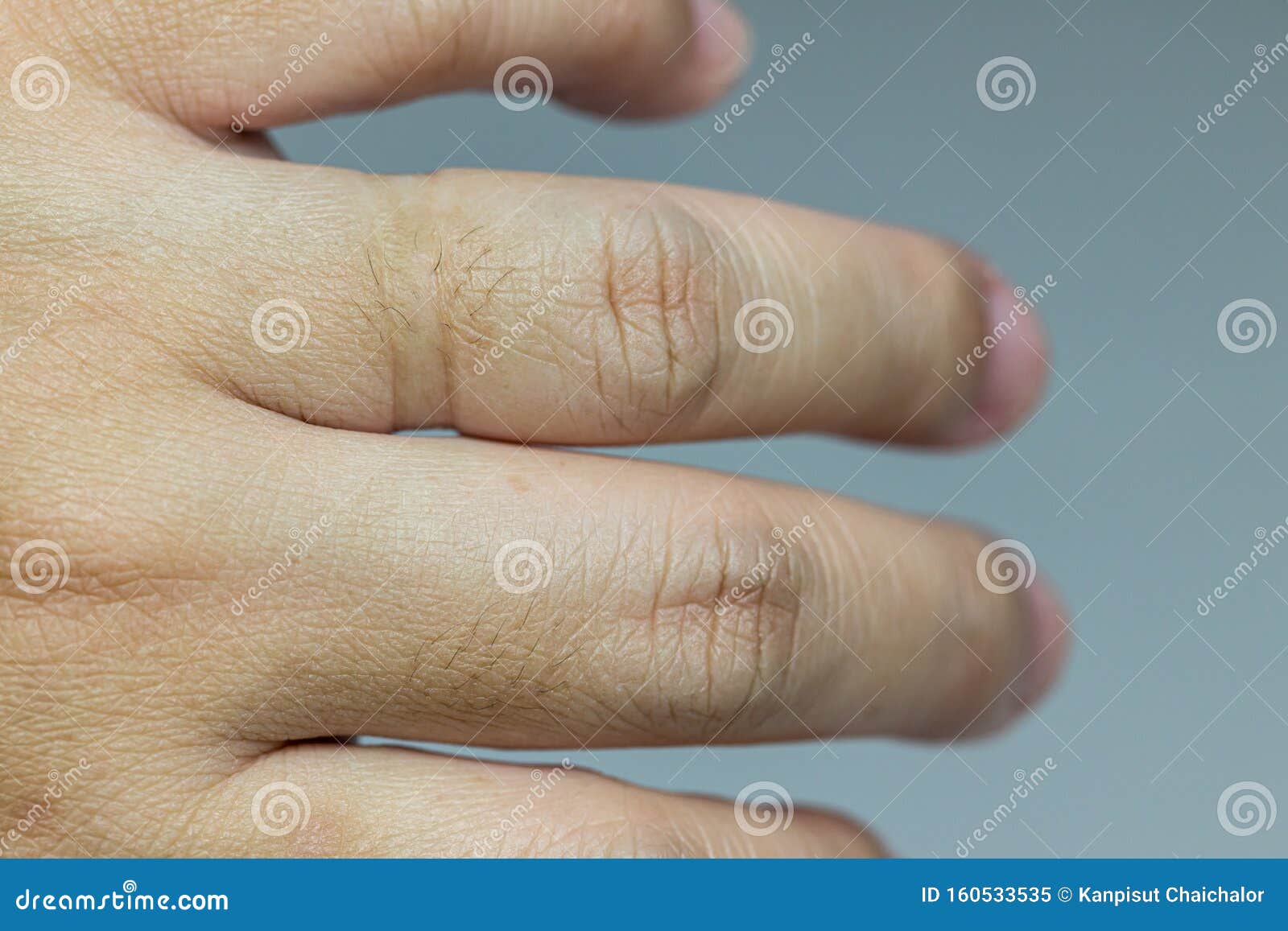 Ring Wound In The Right Hand On The Finger. Part Of A Human Hand Where ...