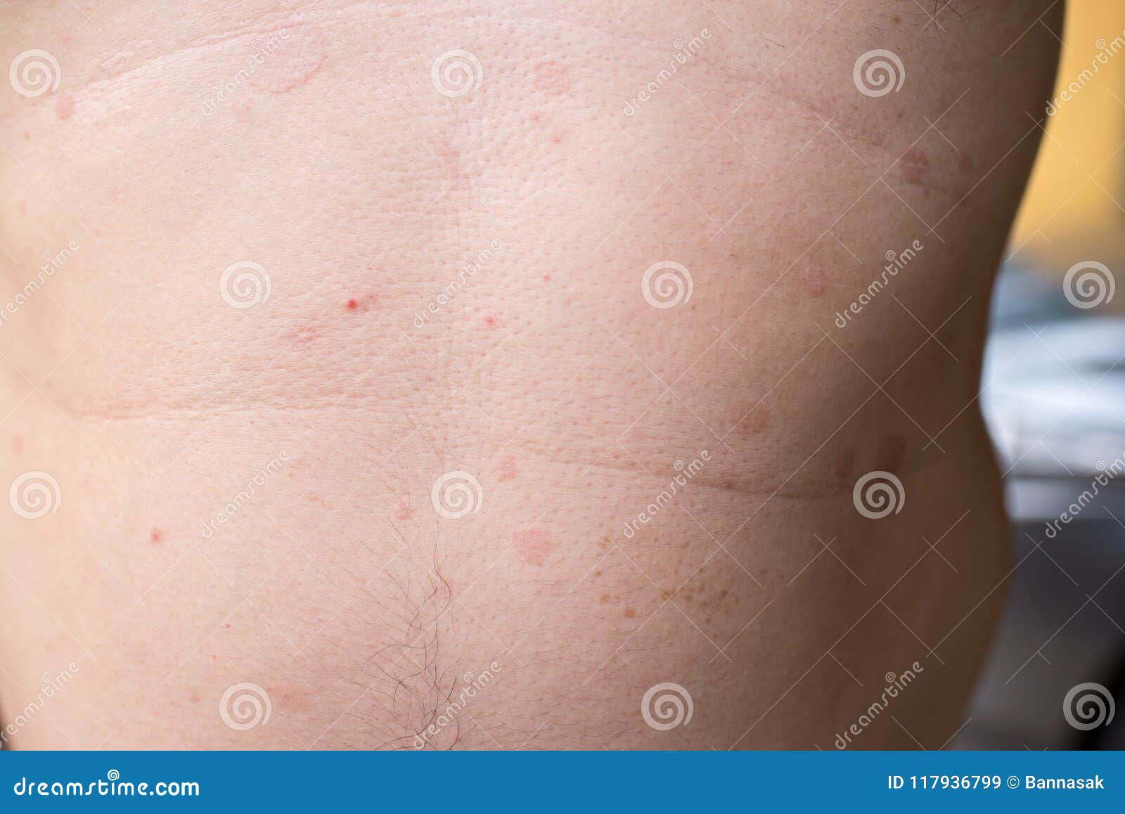 Ringworm On The Body As Background Stock Photo | CartoonDealer.com ...