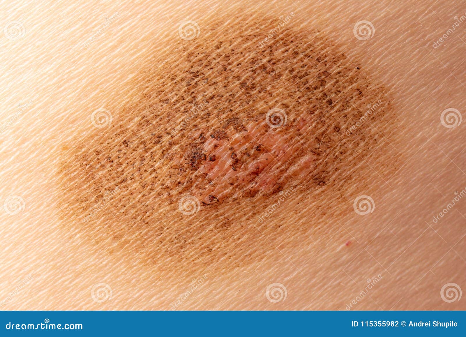 Ringworm on the Human Skin As a Background Stock Photo - Image of ...
