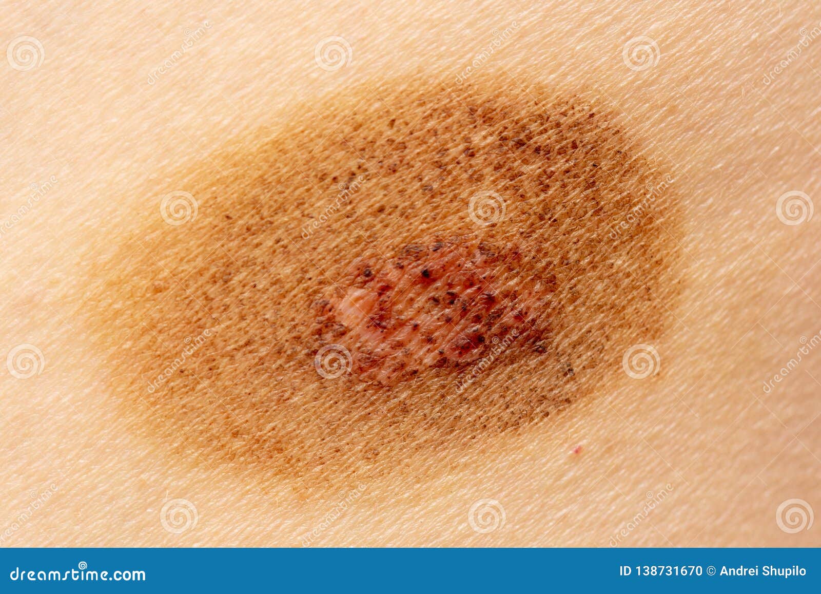 Ringworm on the Human Skin As a Background Stock Photo - Image of ...