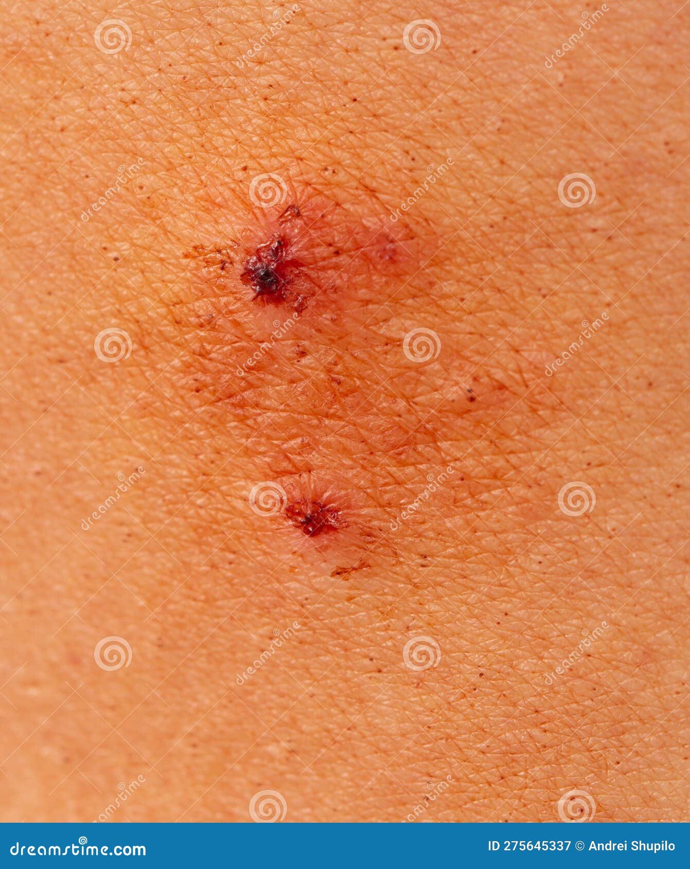 Ringworm on Human Skin As a Background. Macro. Stock Image - Image of ...