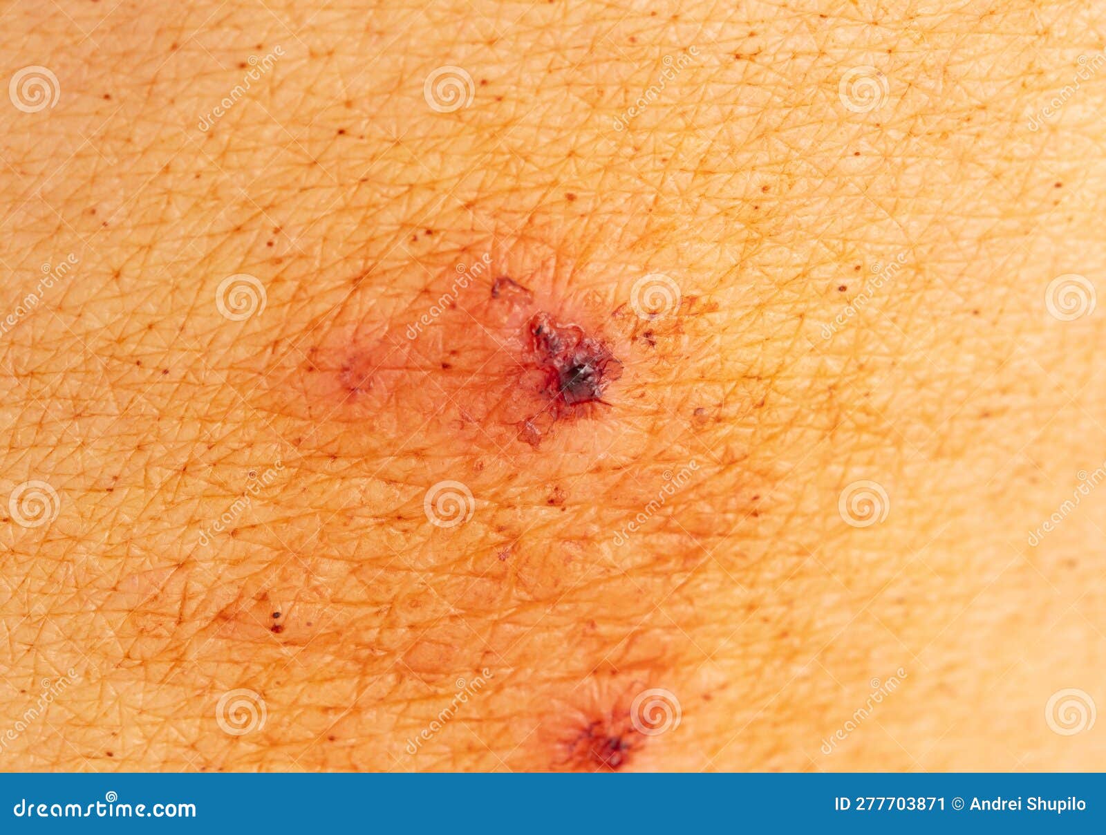 Ringworm on Human Skin As a Background. Macro. Stock Image - Image of ...