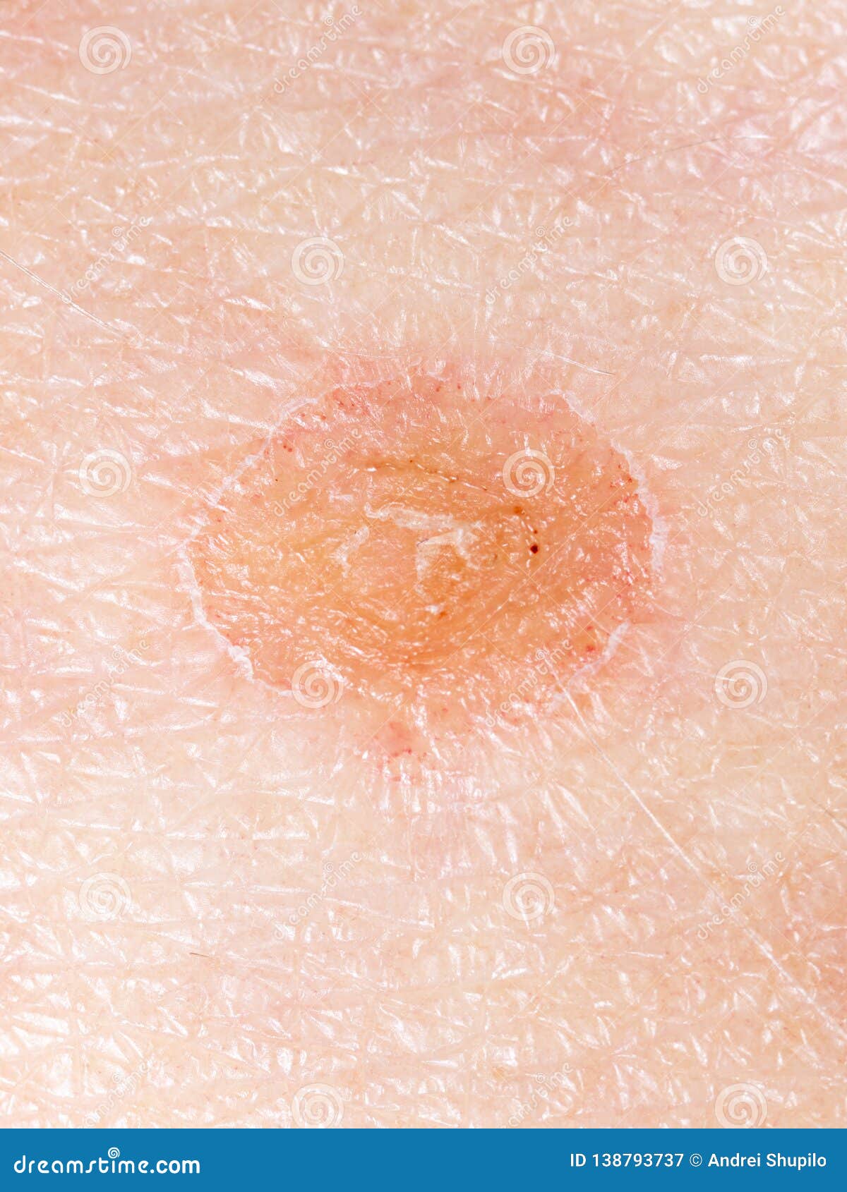 Ringworm on the Human Skin As a Background Stock Image - Image of white ...