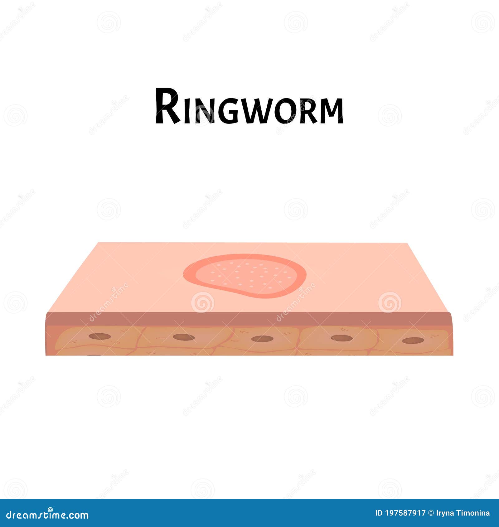 Ringworm On The Skin. Illustration On Isolated Background Royalty-Free ...