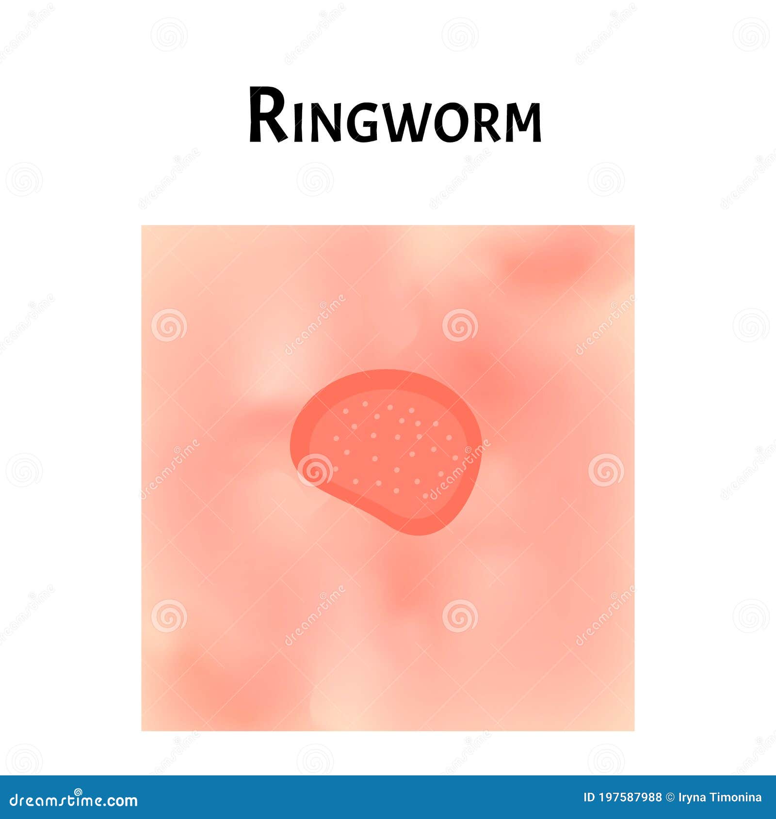 Ringworm On The Skin. Illustration On Isolated Background Royalty-Free ...
