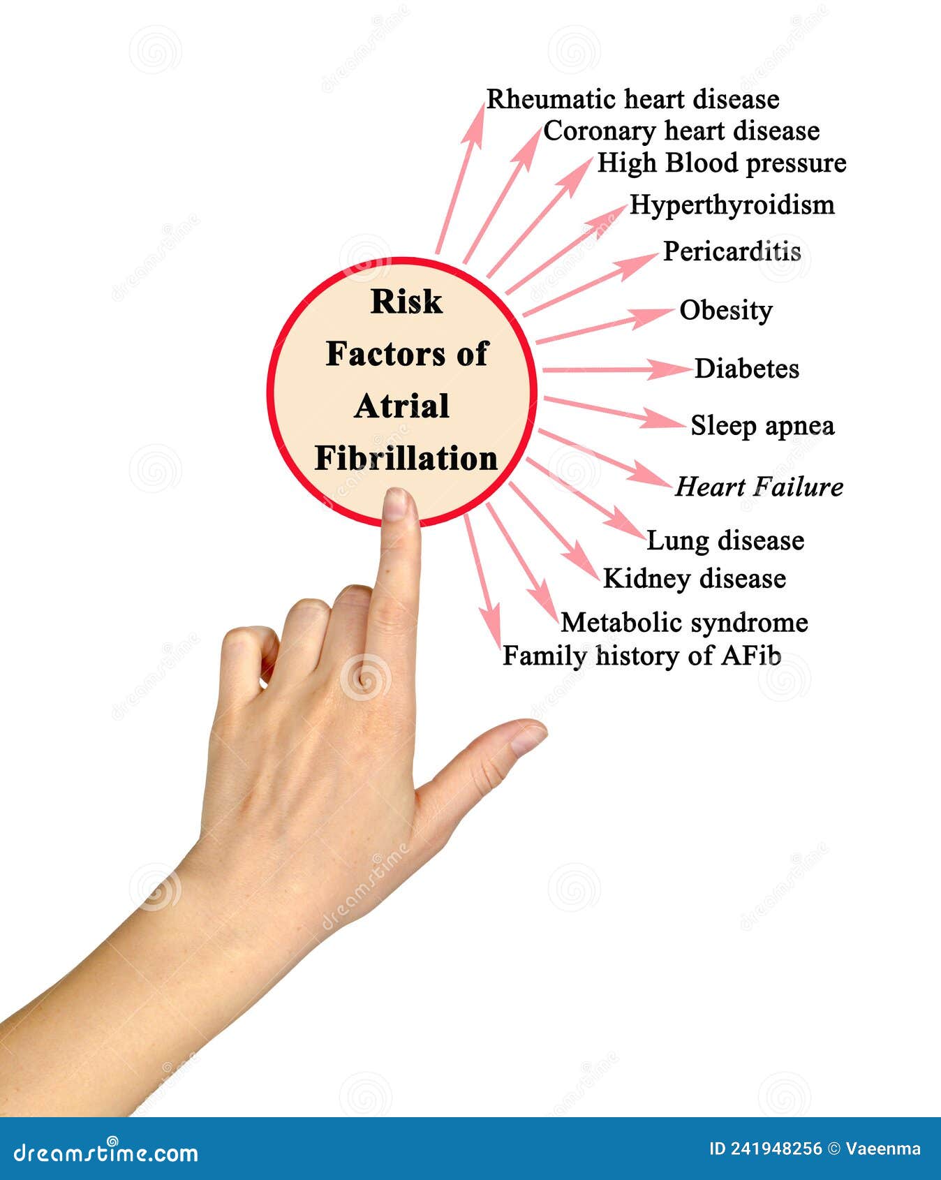 Risk Factors of Atrial Fibrillation Stock Photo - Image of lung ...