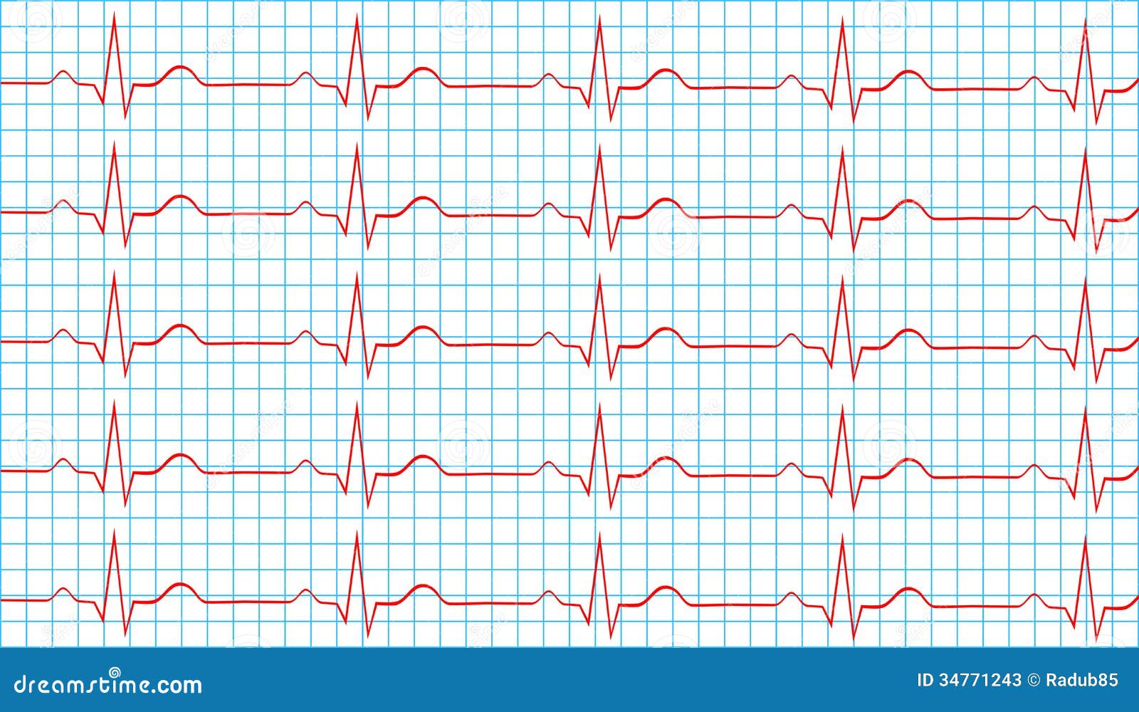 Ritmo Sinusale Normale Del Cuore Sull'elettrocardiogramma Illustrazione ...