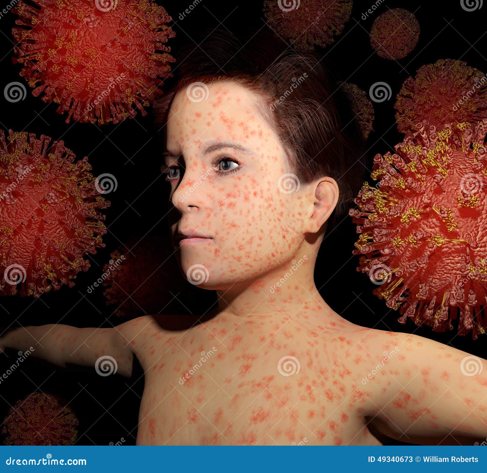 Ritorno di morbillo illustrazione di stock. Illustrazione di anticorpo ...