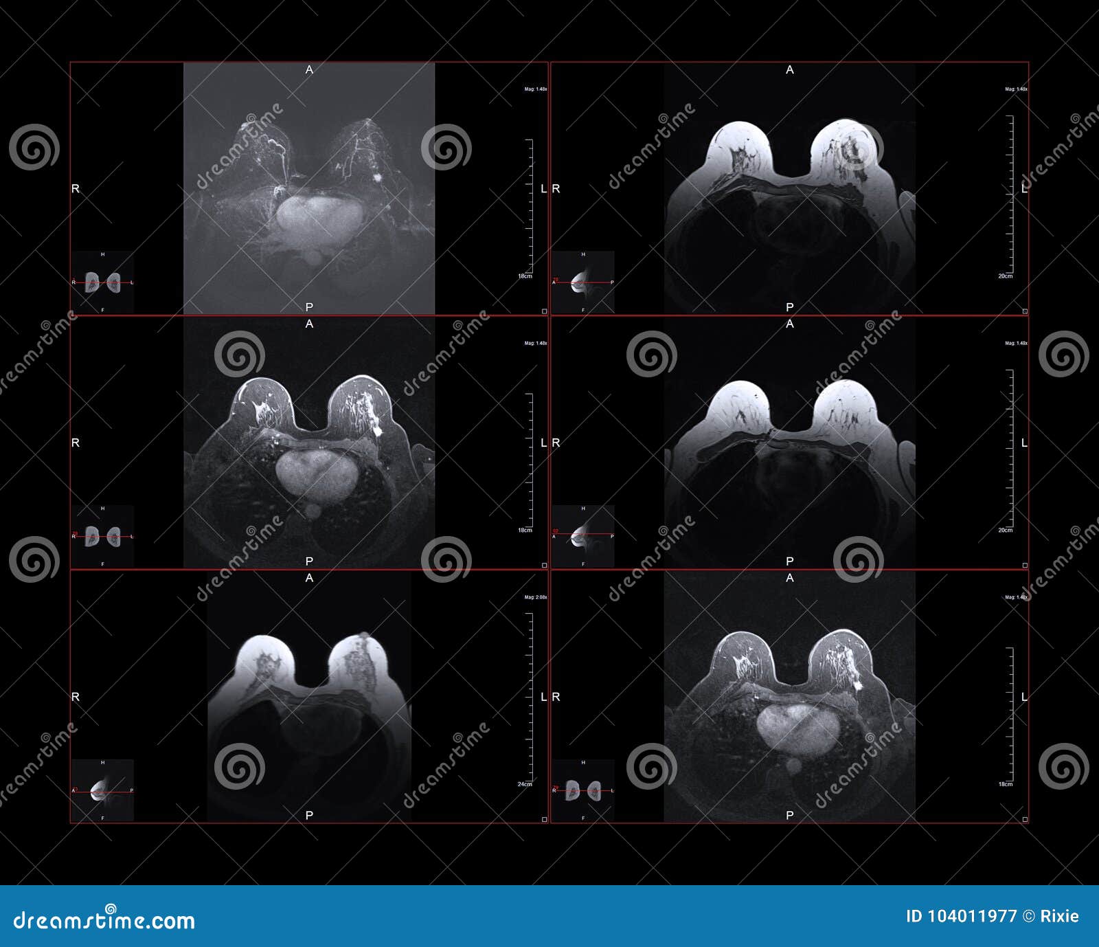 RMI del cancro al seno immagine stock. Immagine di immagine - 104011977