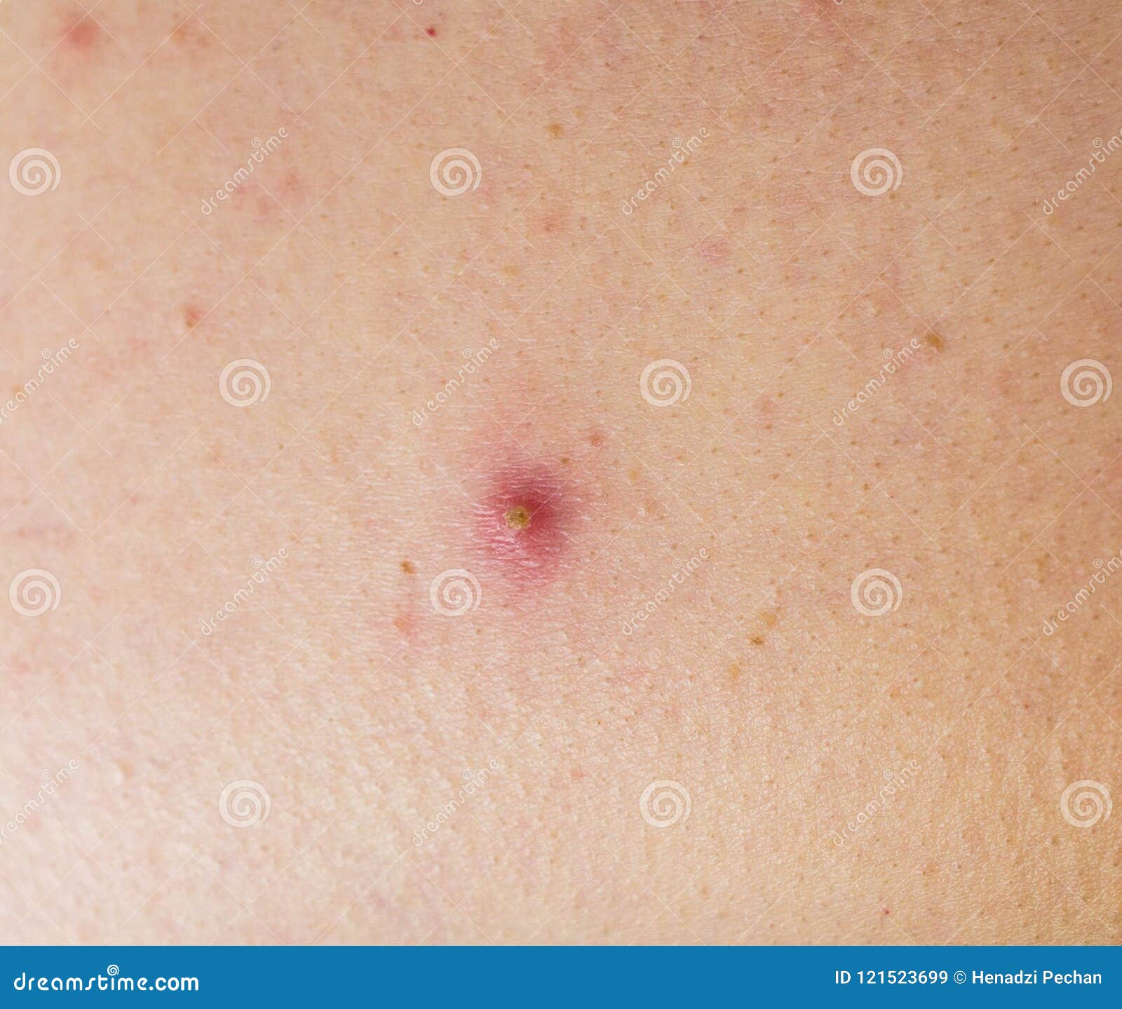 Rode Pukkel Op Gezichtsmacro, Abces En Acne Stock Afbeelding - Image of ...