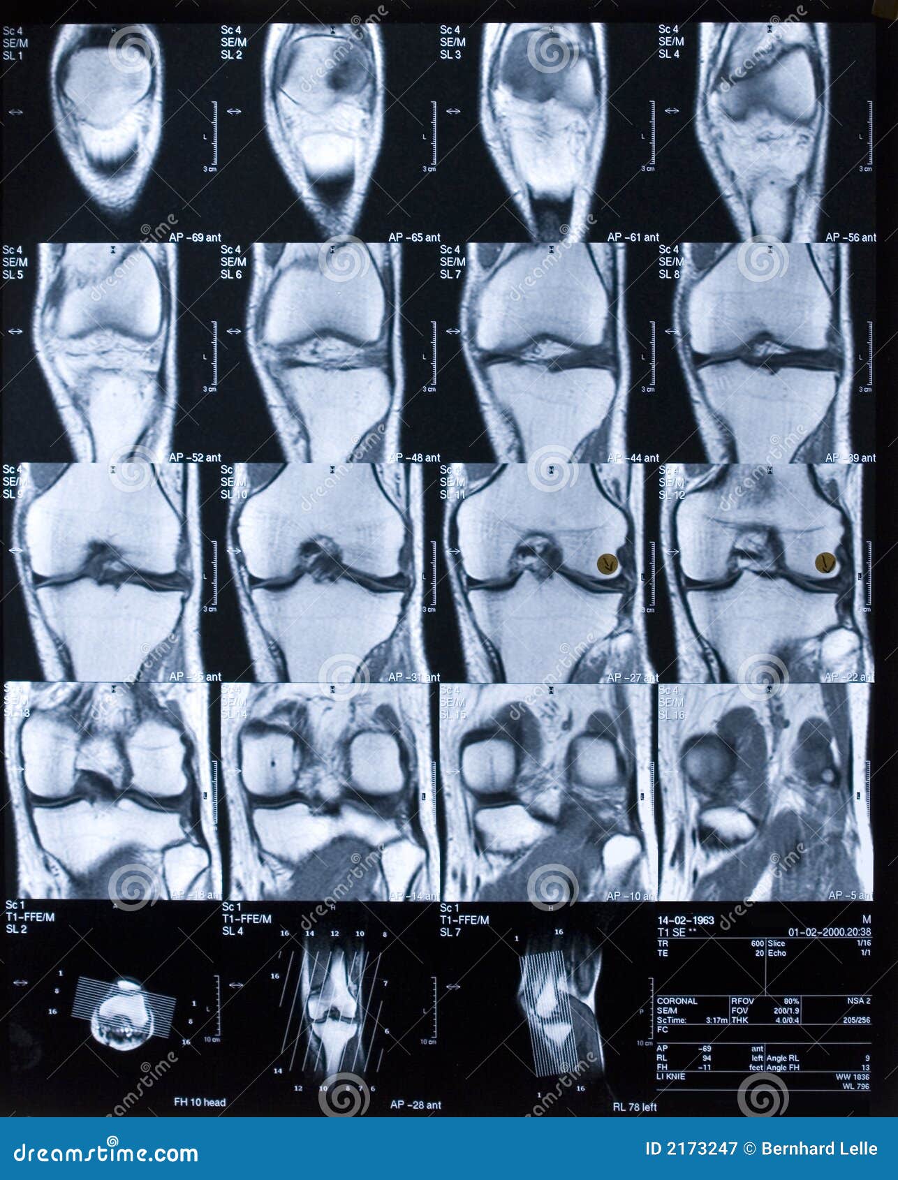 Rodilla 3 de MRI imagen de archivo. Imagen de magnético - 2173247