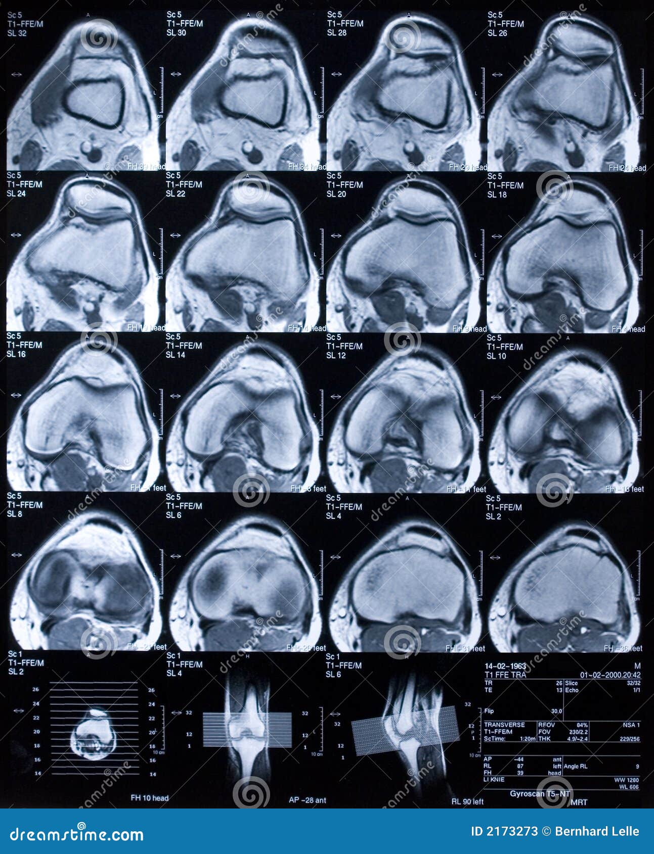 Rodilla 4 de MRI imagen de archivo. Imagen de medicina - 2173273