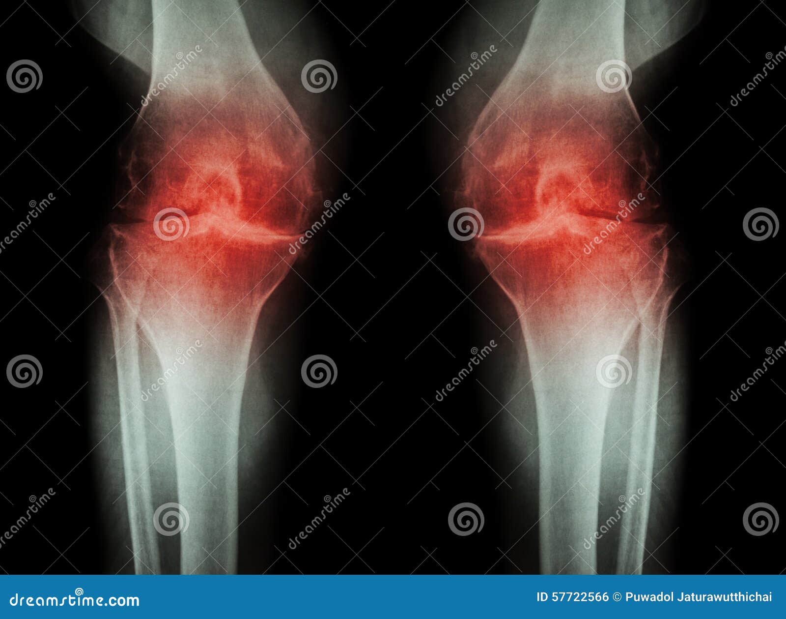 Rodilla De La Osteoartritis (rodilla) Del OA (radiografía De La ... Rodilla De La Osteoartritis (rodilla) Del OA (radiografía De La ...