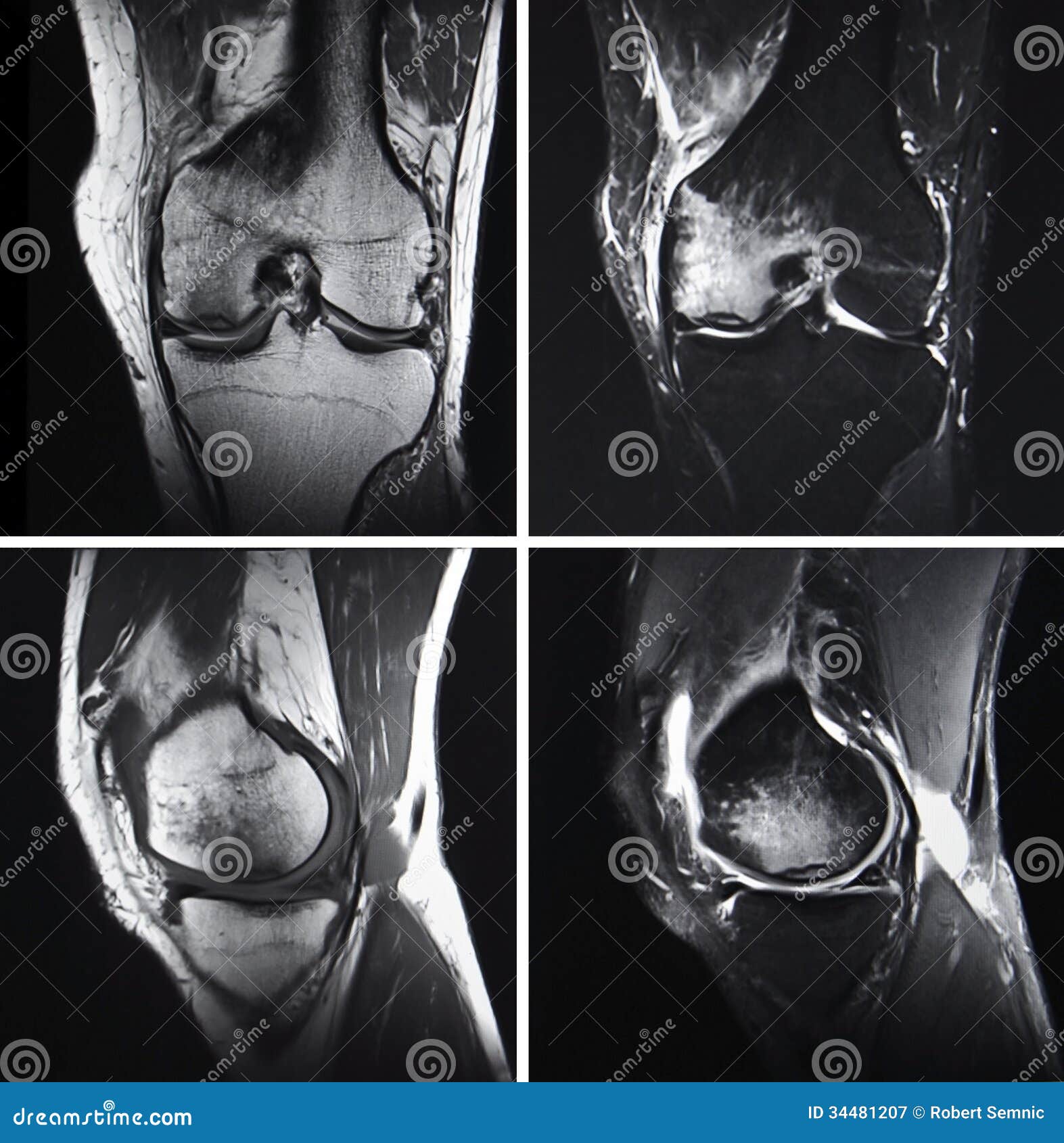 Rodilla herida, MRI imagen de archivo. Imagen de procedimiento - 34481207