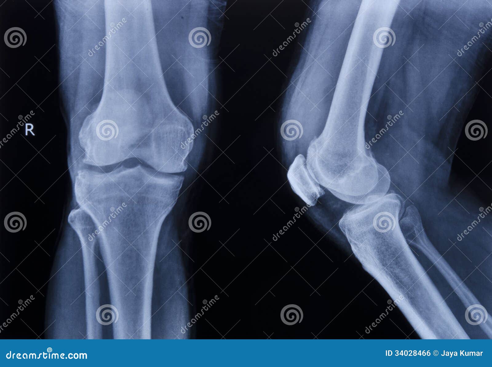 Rodilla Normal De La Radiografía Foto de archivo - Imagen de medicina ...