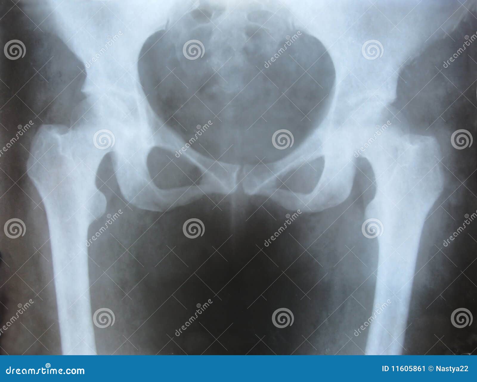Roentgen Film of a Pelvic Bones Stock Image - Image of health, fracture ...