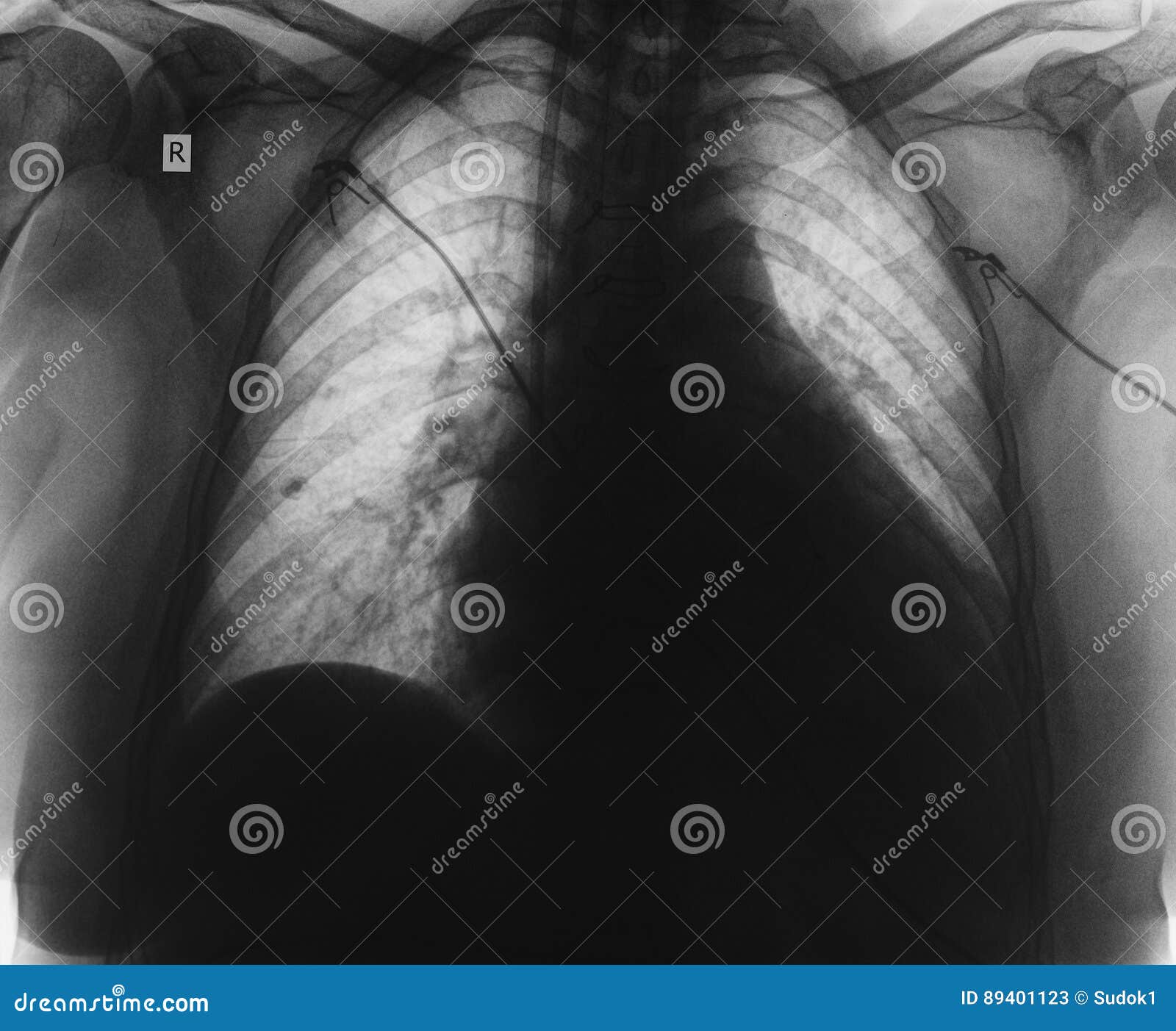 Roentgen Image of Patient in ICU Stock Image - Image of health ...