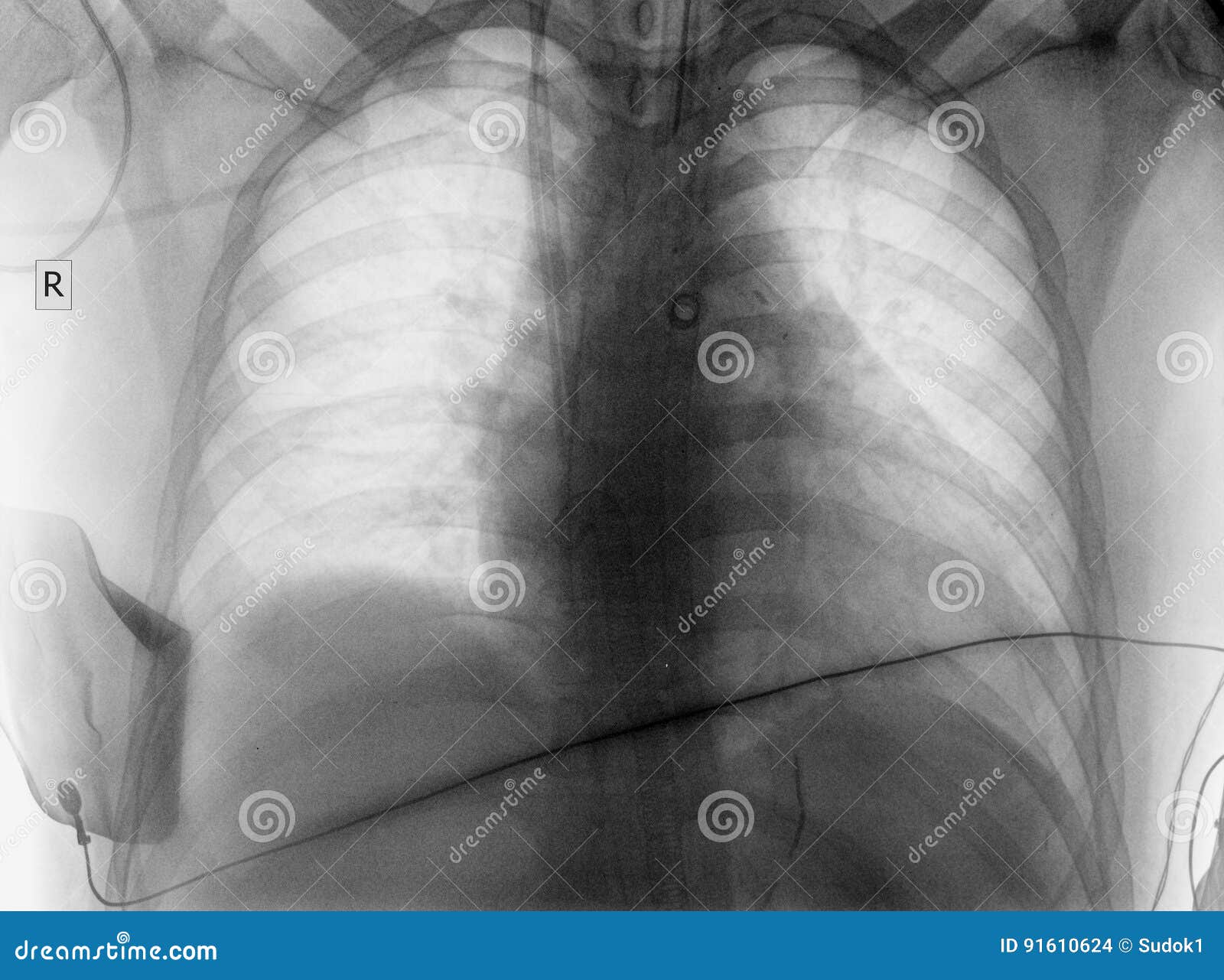 Roentgen Image of Patient in ICU Stock Illustration - Illustration of ...